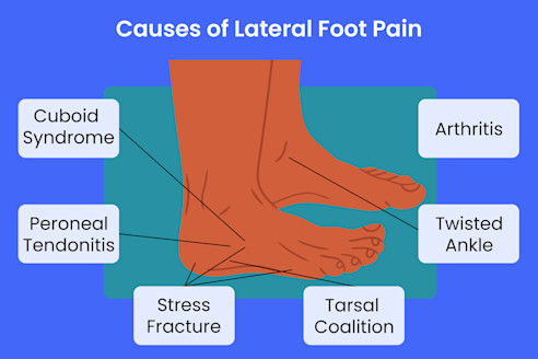 Lateral Foot Pain: Symptoms, Causes and Treatment