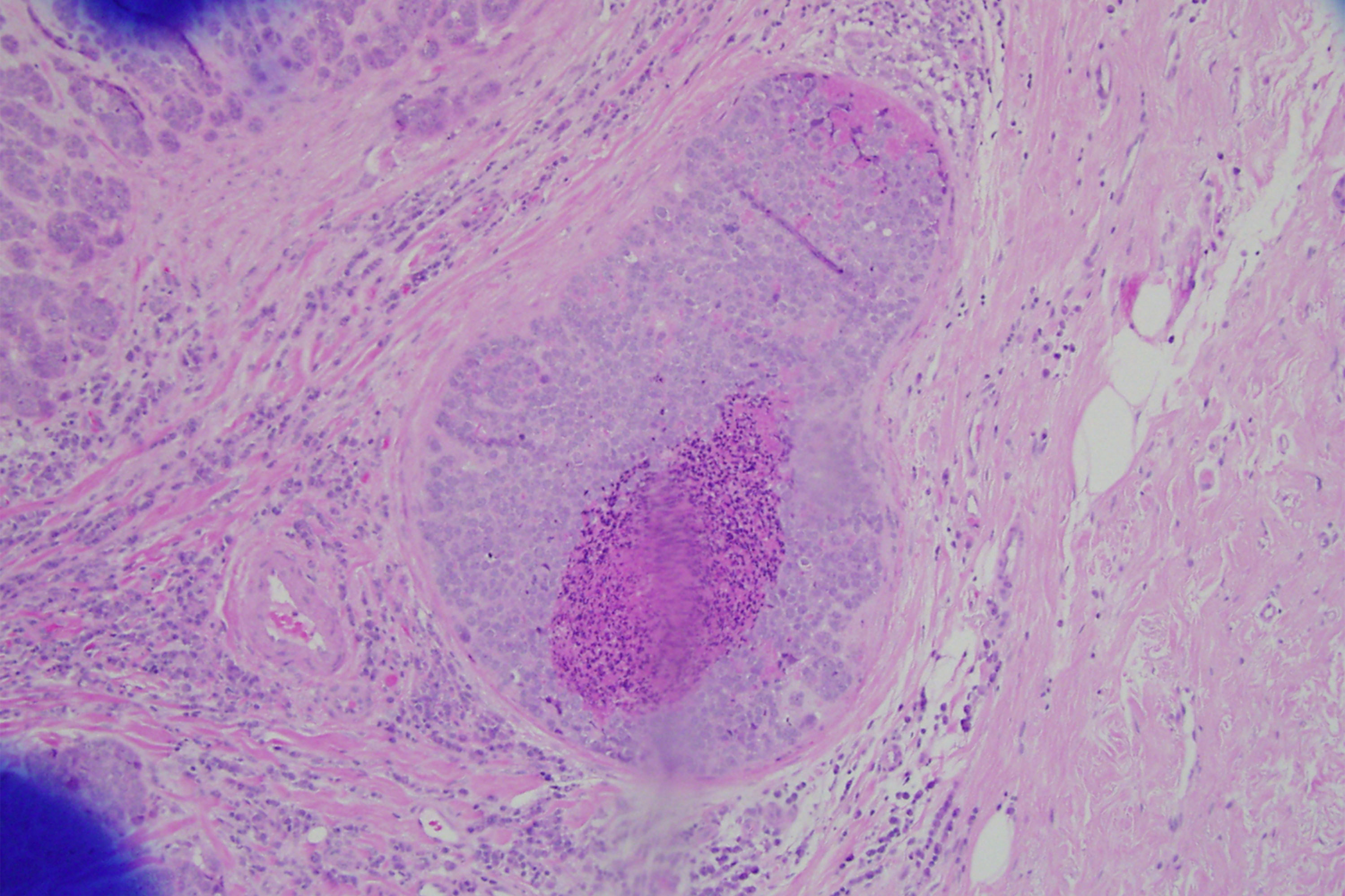 What Is Comedocarcinoma?