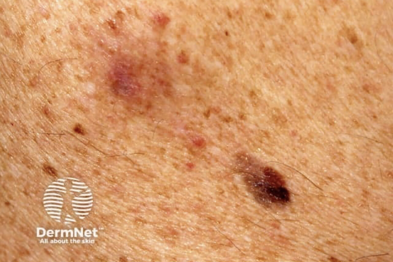 What Does a Cancerous Mole Look Like?