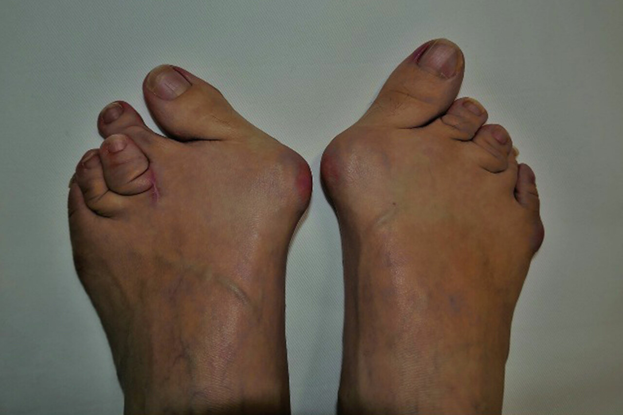 Types of Psoriatic Arthritis