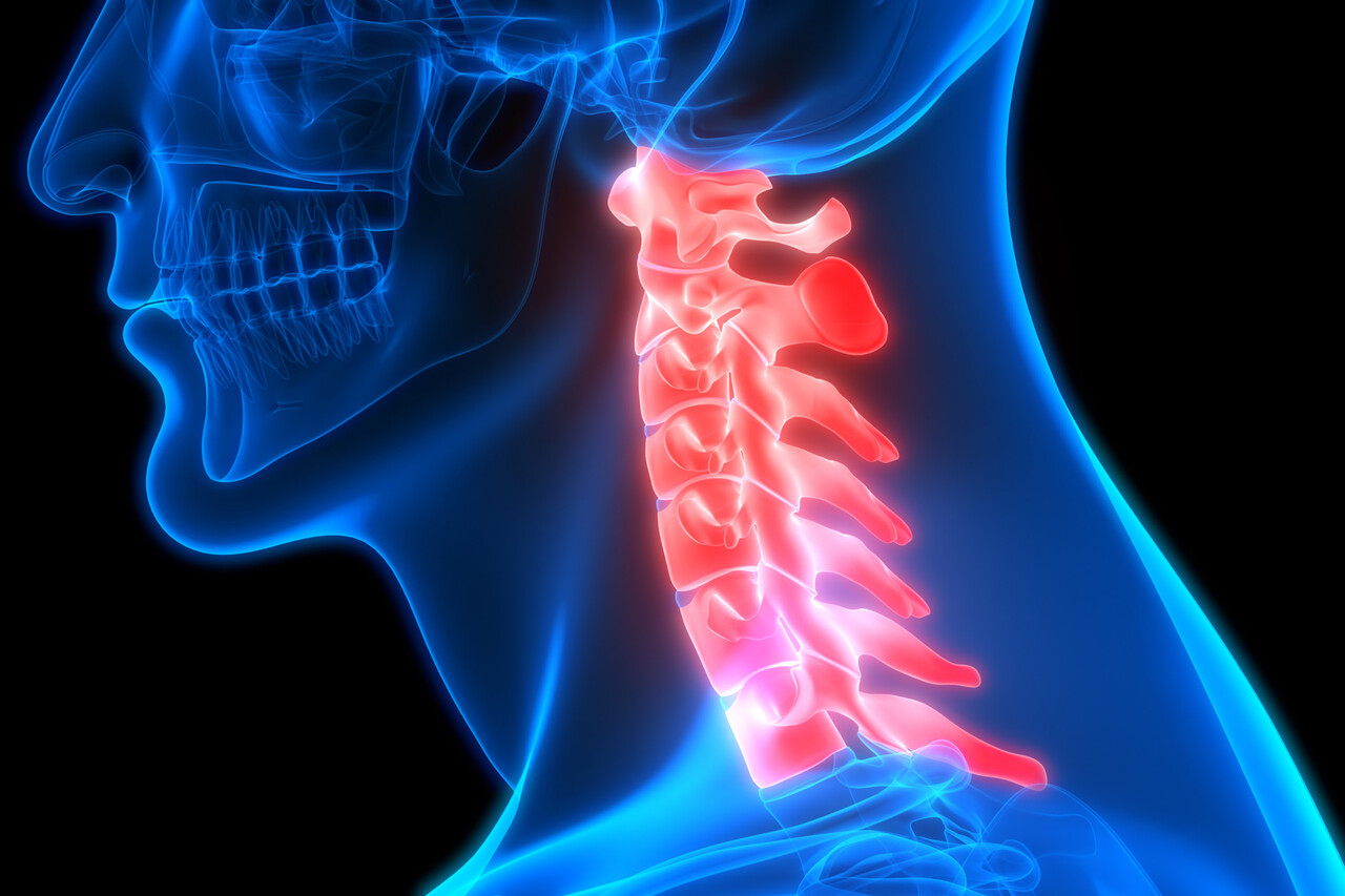 Psoriatic Arthritis Neck Pain: Causes and How to Treat It
