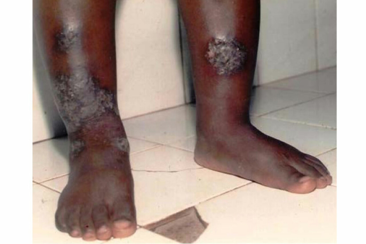 Nummular Eczema: Symptoms, Causes and Treatment