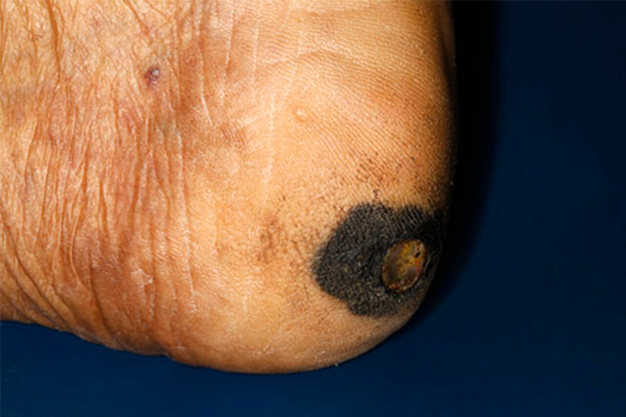 What Is Metastatic Melanoma and Where Can It Spread?