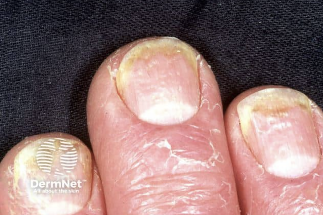 How Can Alopecia Areata Cause Nail Changes?