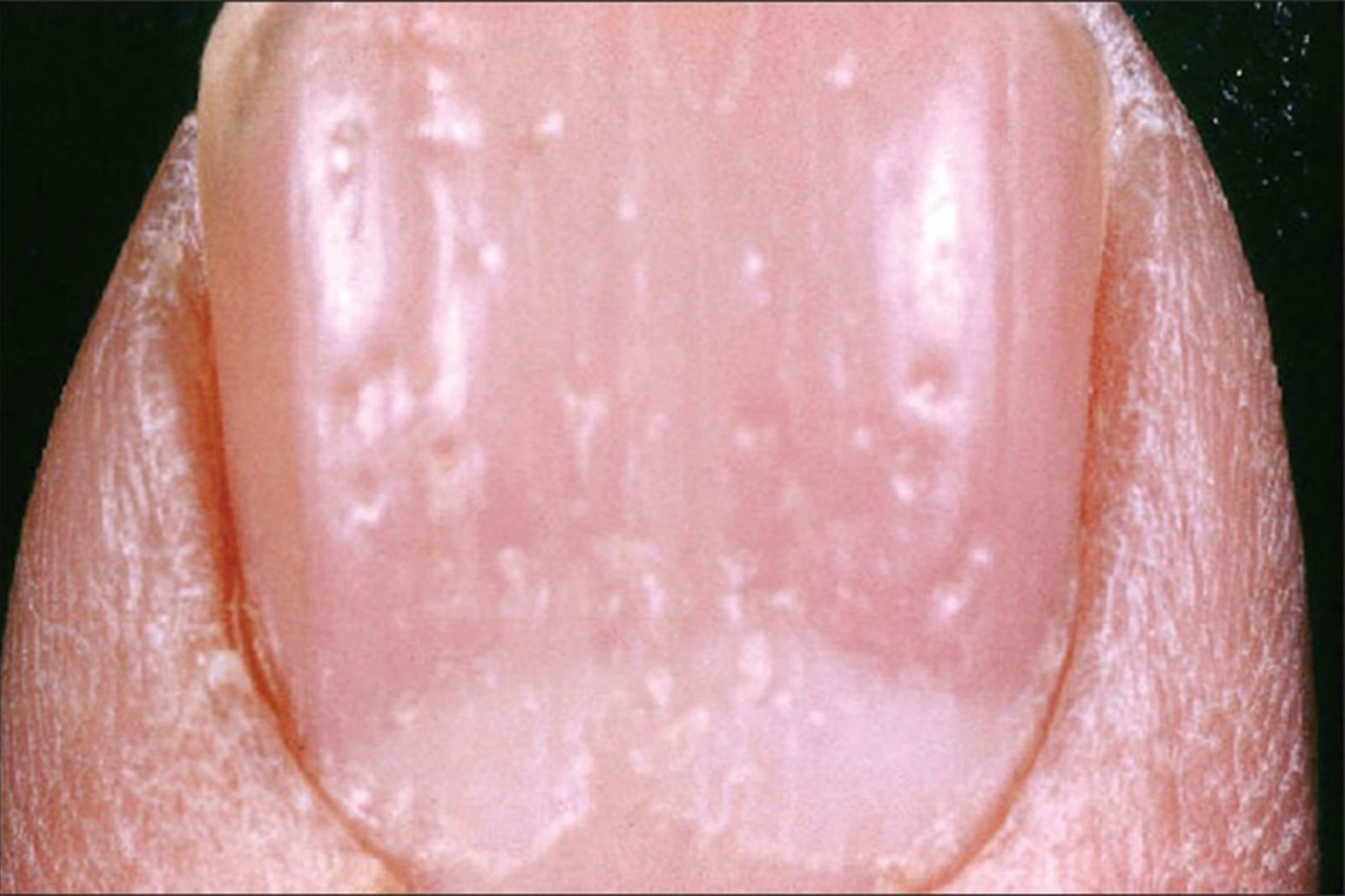 Nail Psoriasis Severity Index (NAPSI): What It Is, What It Measures