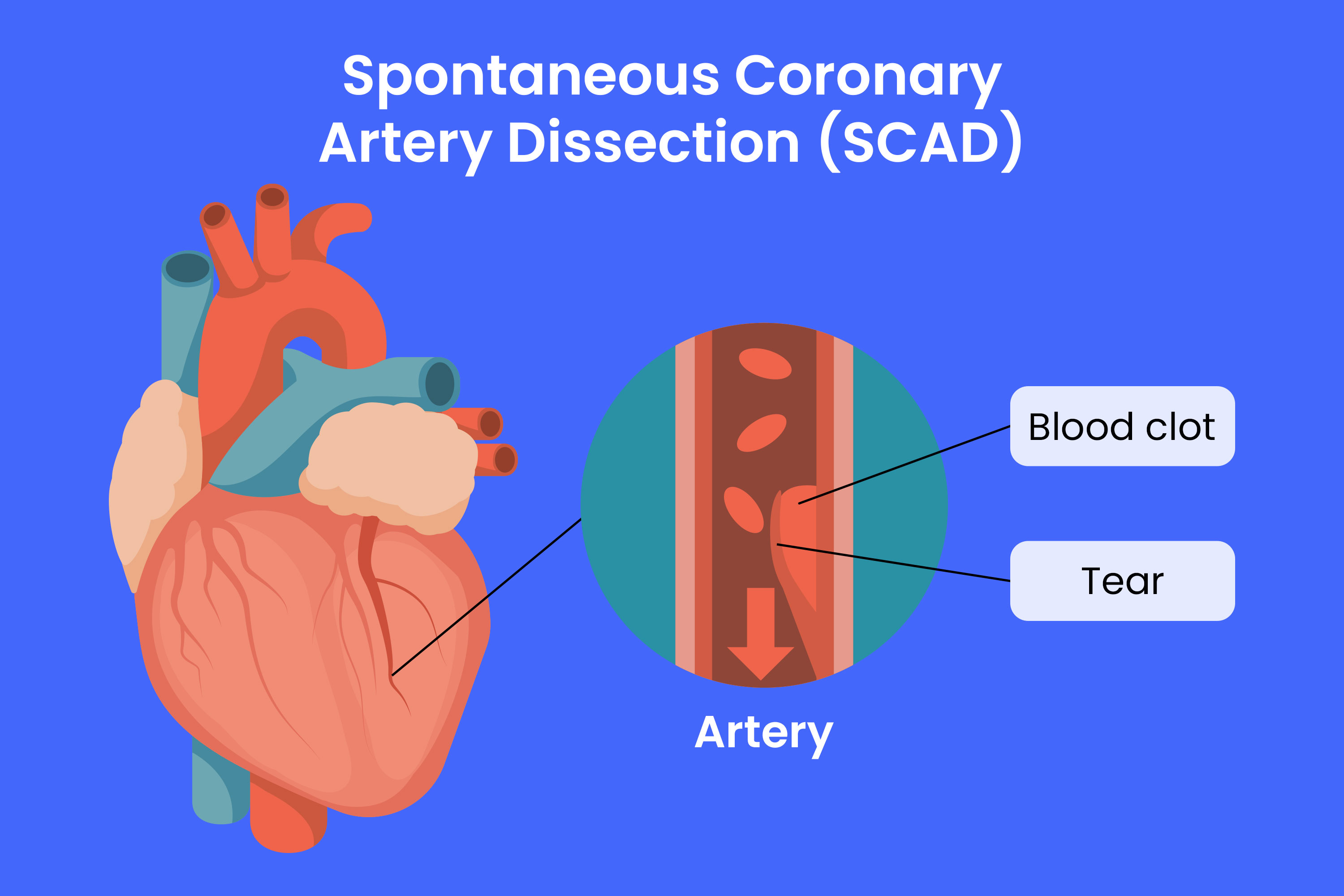 Spontaneous Coronary Artery Dissection (SCAD): What Is It?