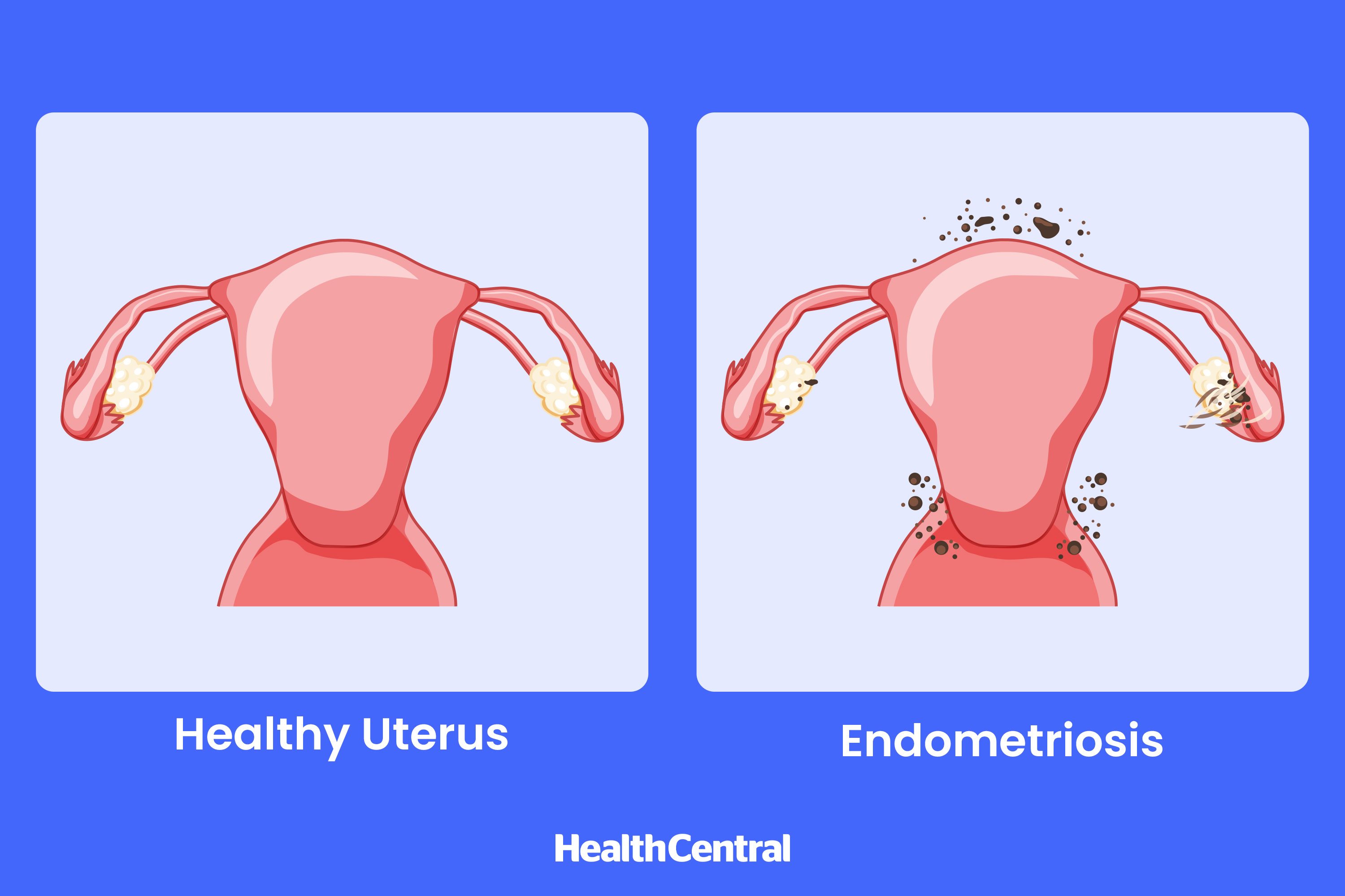 Pictures of Endometriosis: Visual Guide