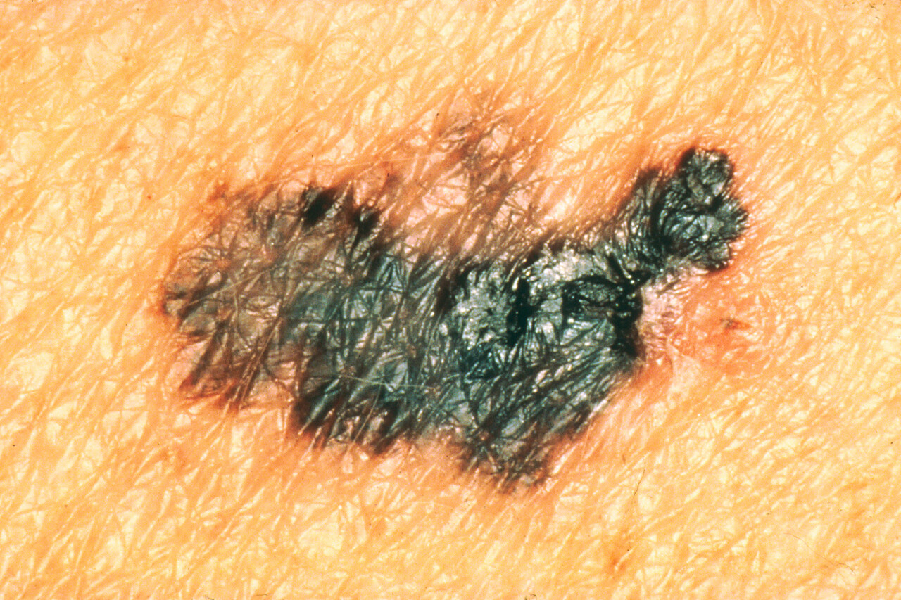 Melanoma Signs & Symptoms