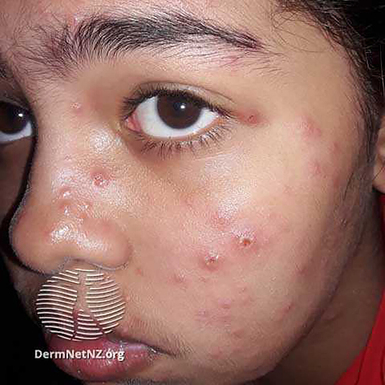 What Can Be Mistaken For Shingles?