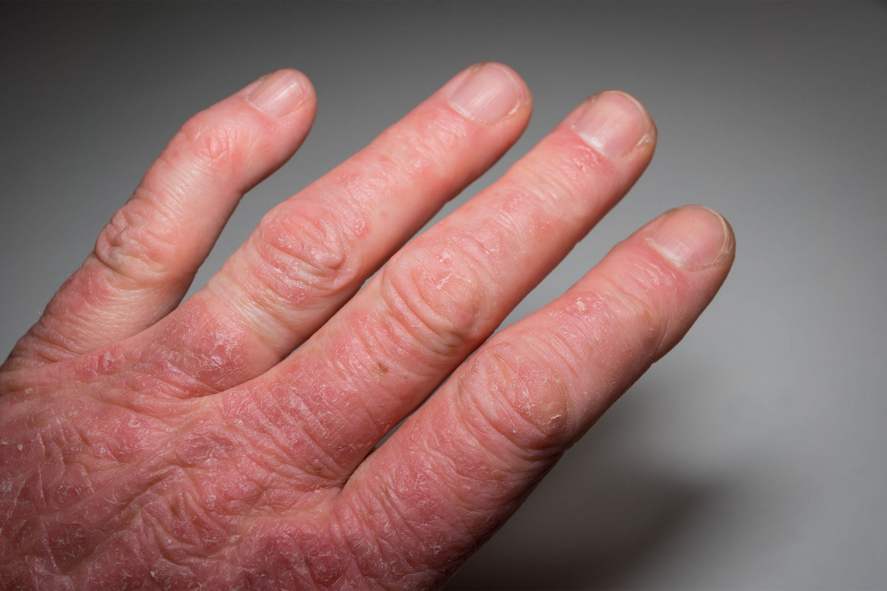 Psoriasis & Psoriatic Arthritis: What’s The Relationship?