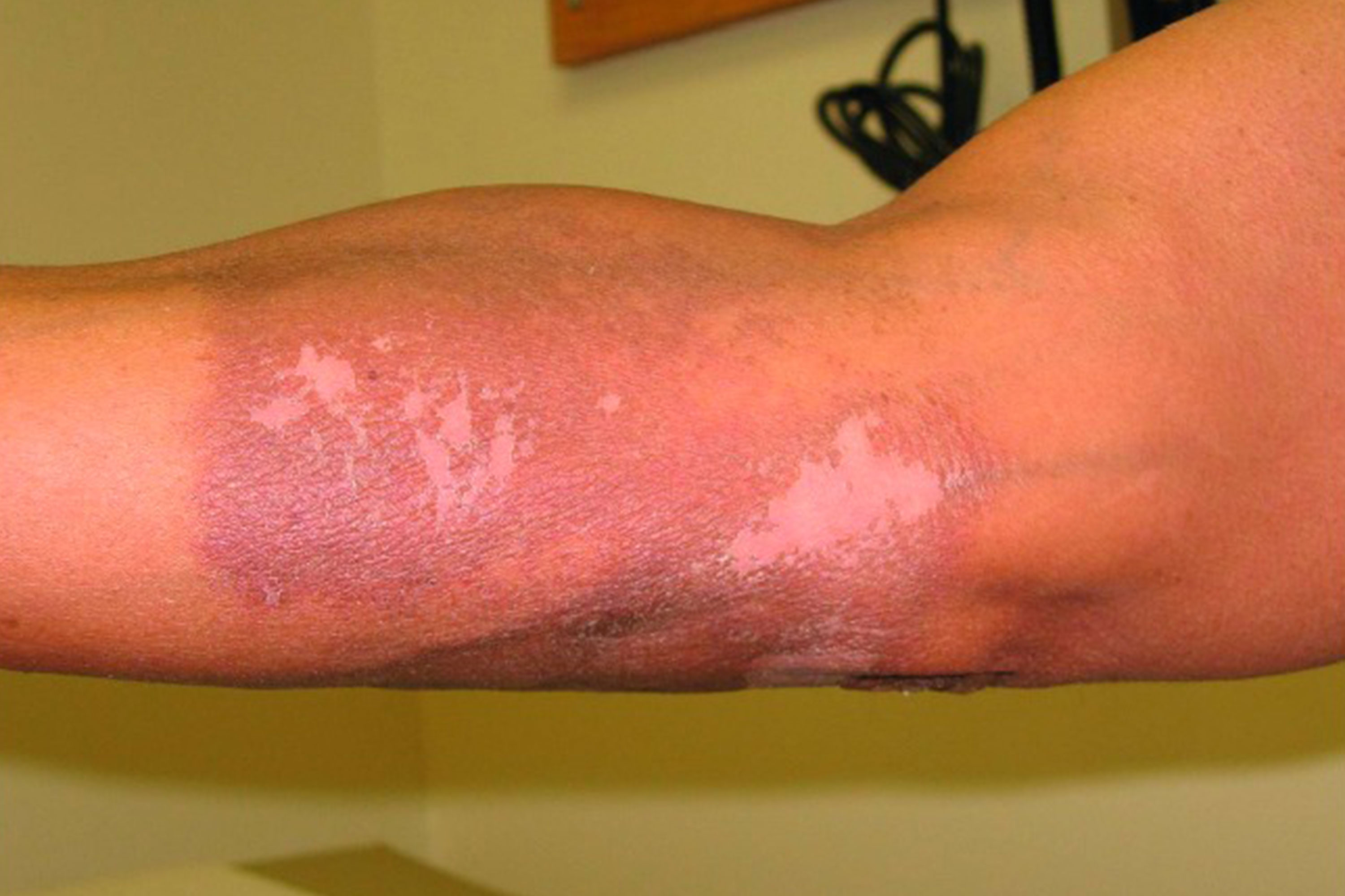 Chemo Rash: Causes, Pictures and Treatment