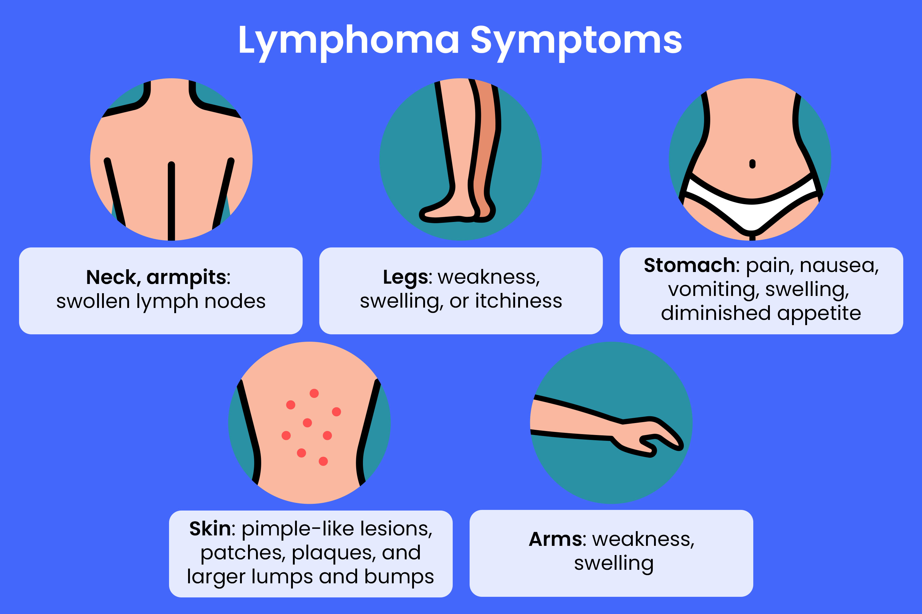 Follicular Lymphoma Symptoms Lymphoma: Symptoms, Causes And Treatment