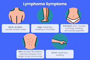 Lymphoma Neck Lymphoma Neck