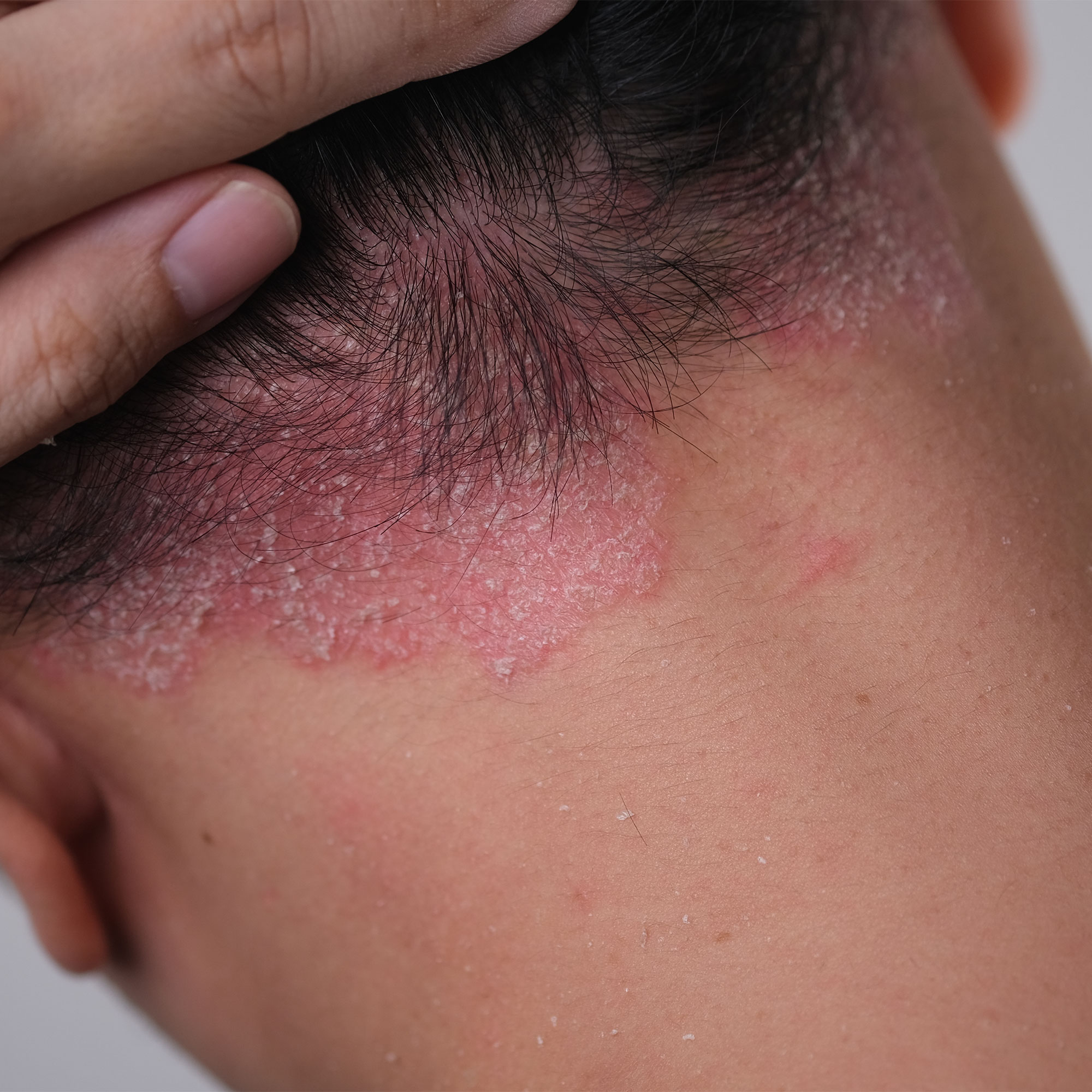 Pros and Cons of Topical vs. Oral Treatment for Psoriasis