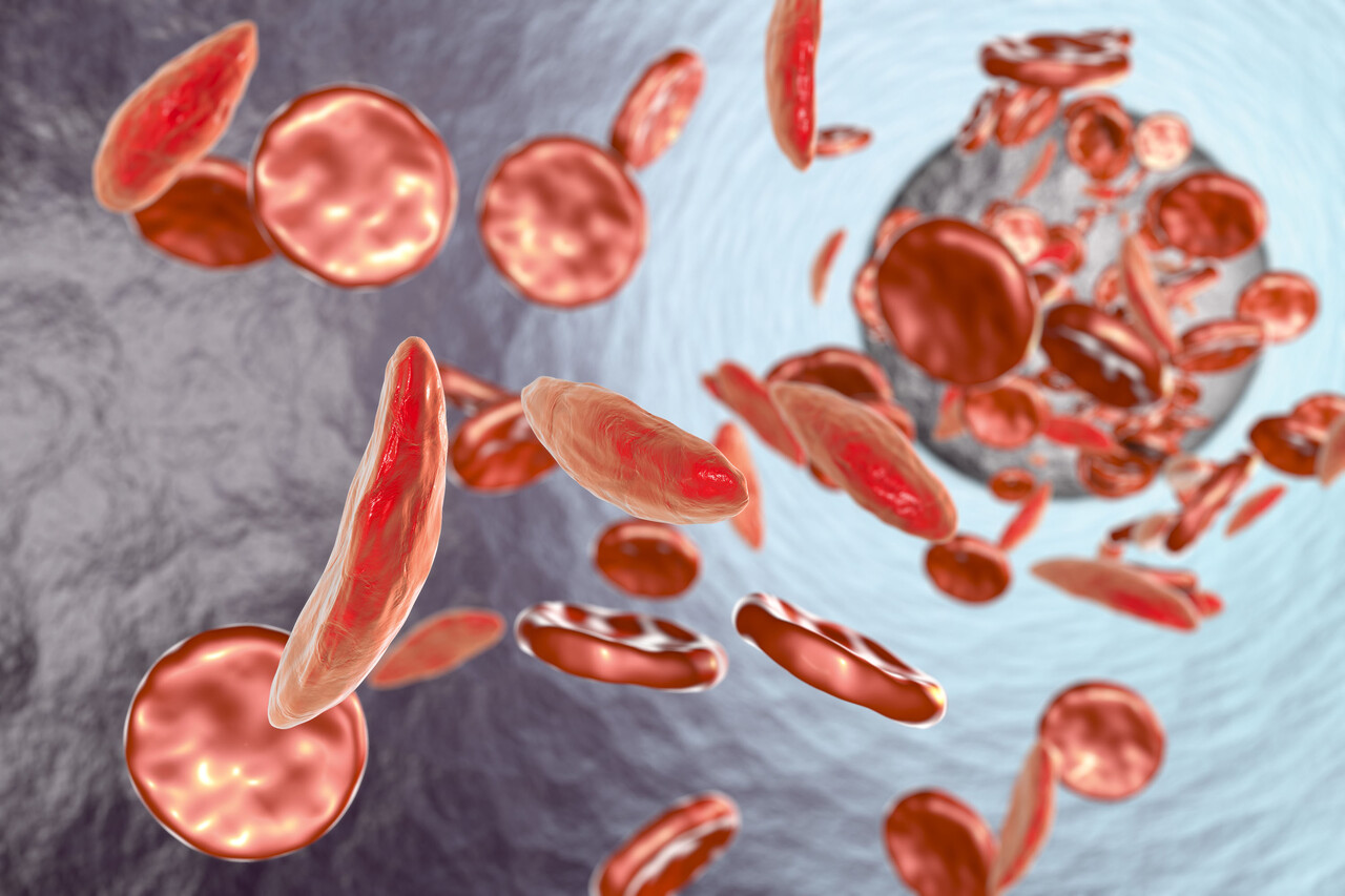 Treatment Options for Sickle Cell Disease