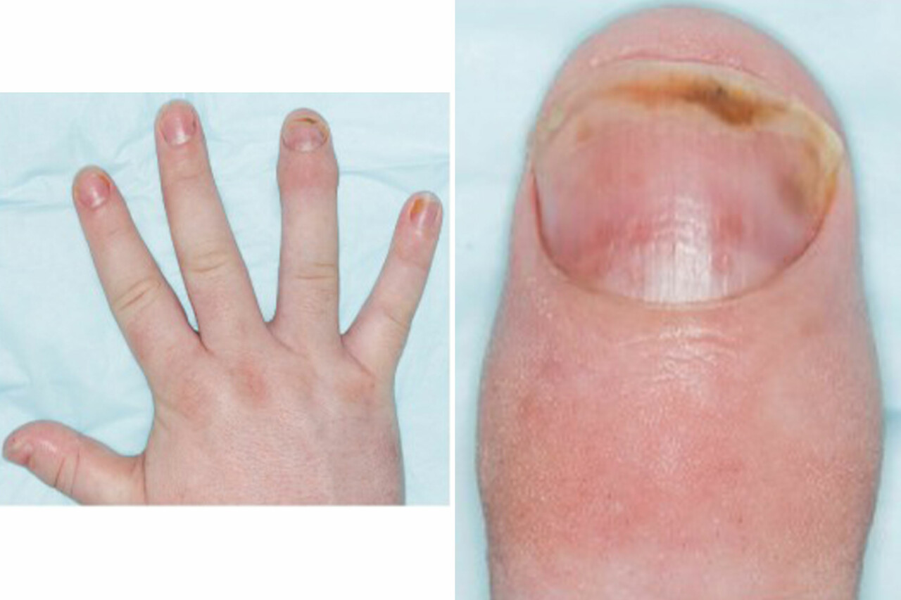 Types of Psoriatic Arthritis