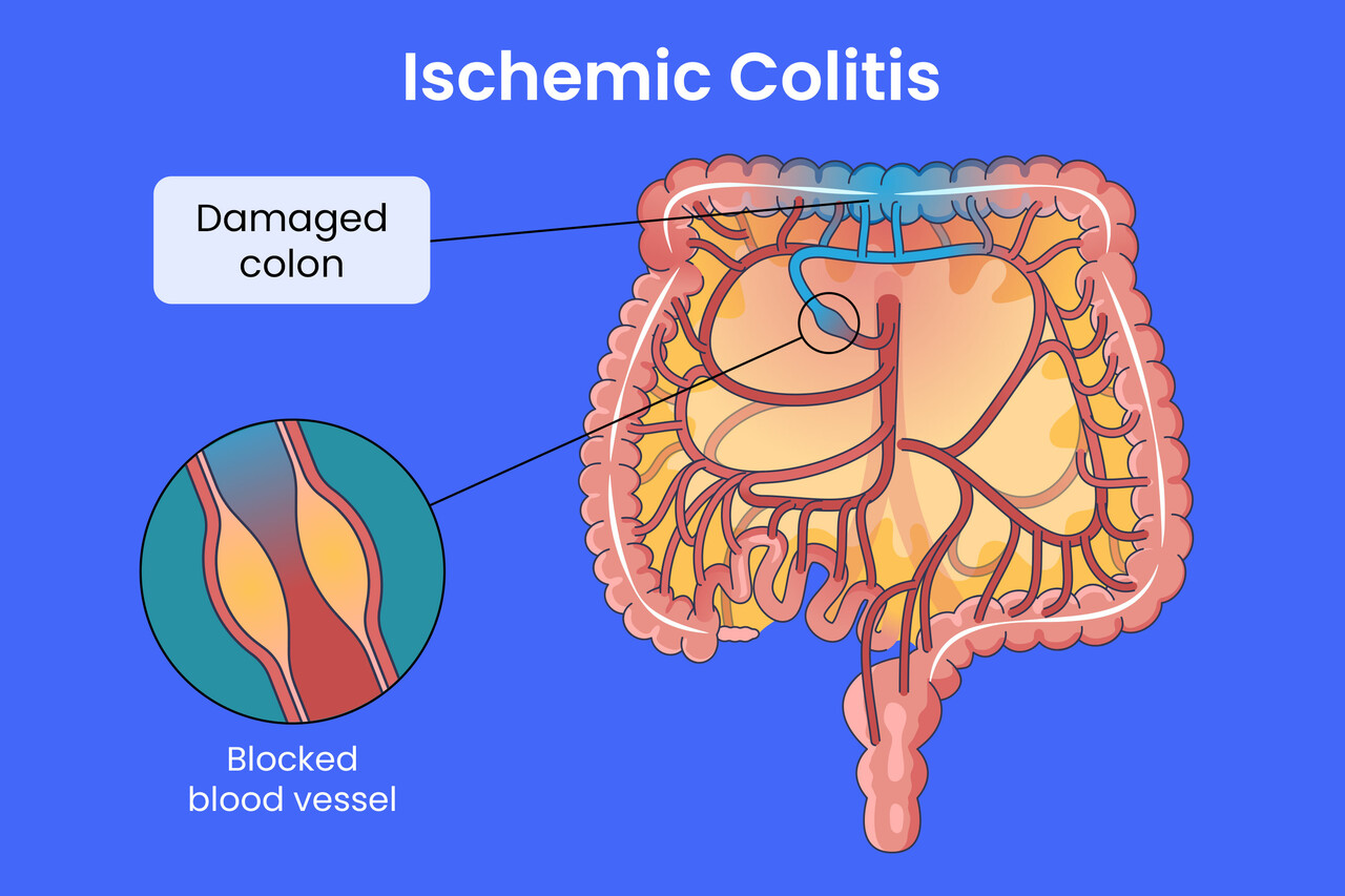 Ischemic Colitis: Symptoms, Causes and Treatment