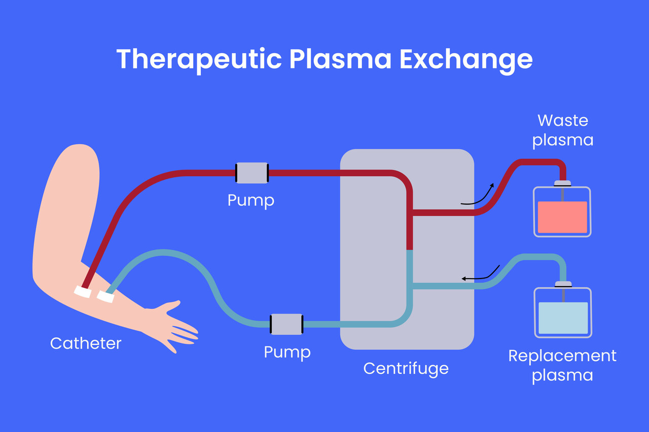 Plasma Exchange for MS: Benefits, Risks, and Efficacy