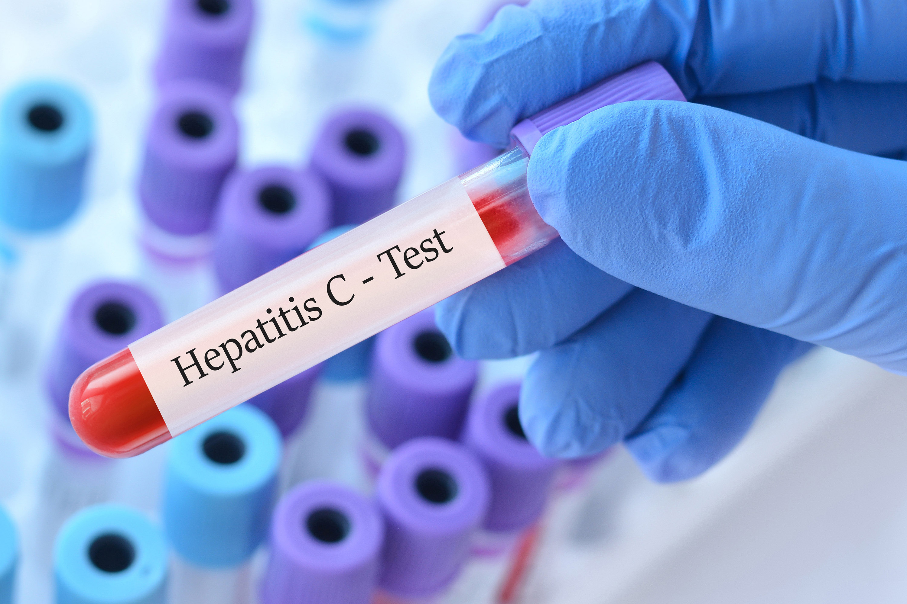 What to Expect During Hepatitis C Treatment