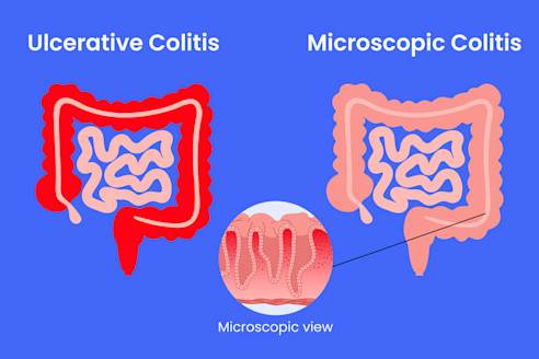 Microscopic Colitis vs Ulcerative Colitis: Understanding the Differences