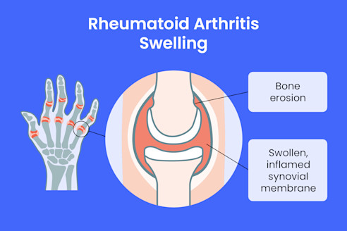 Rheumatoid Arthritis Swelling: Causes, Effects, and Treatment