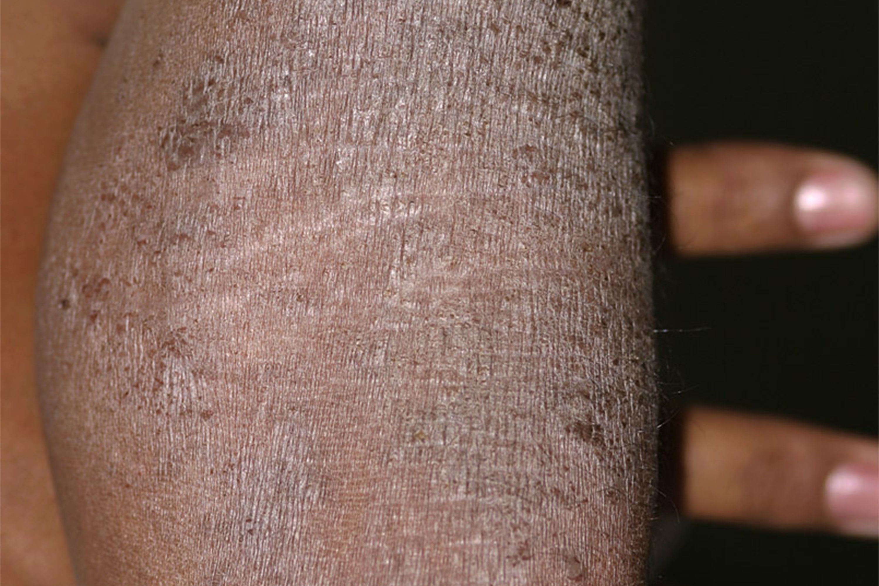 Eczema On Upper Arms Eczema Herpeticum: Pictures, Stages And Treatment