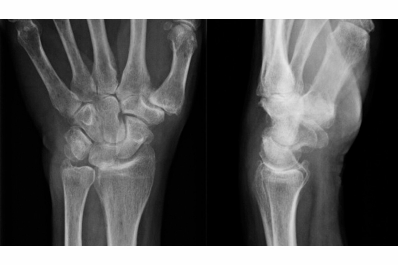 Rheumatoid Arthritis in the Wrist: Symptoms, Treatments and More