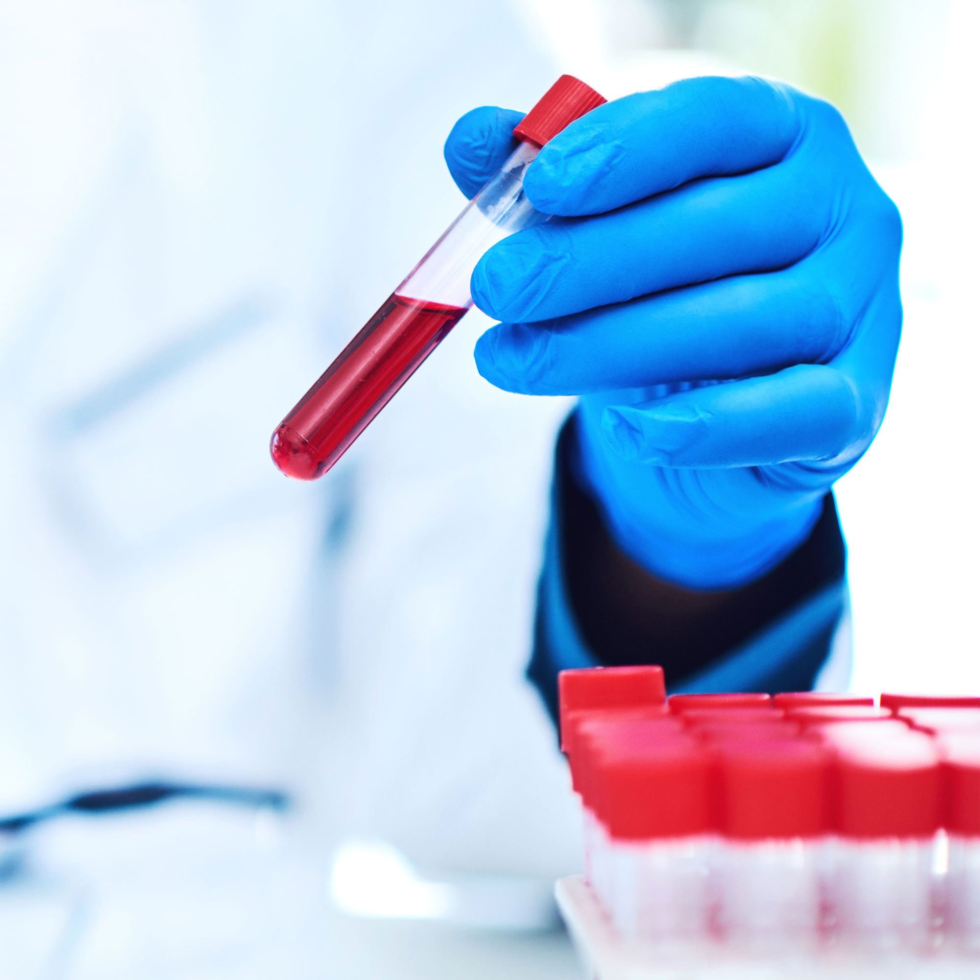 Tests Doctors Use to Diagnose Myasthenia Gravis