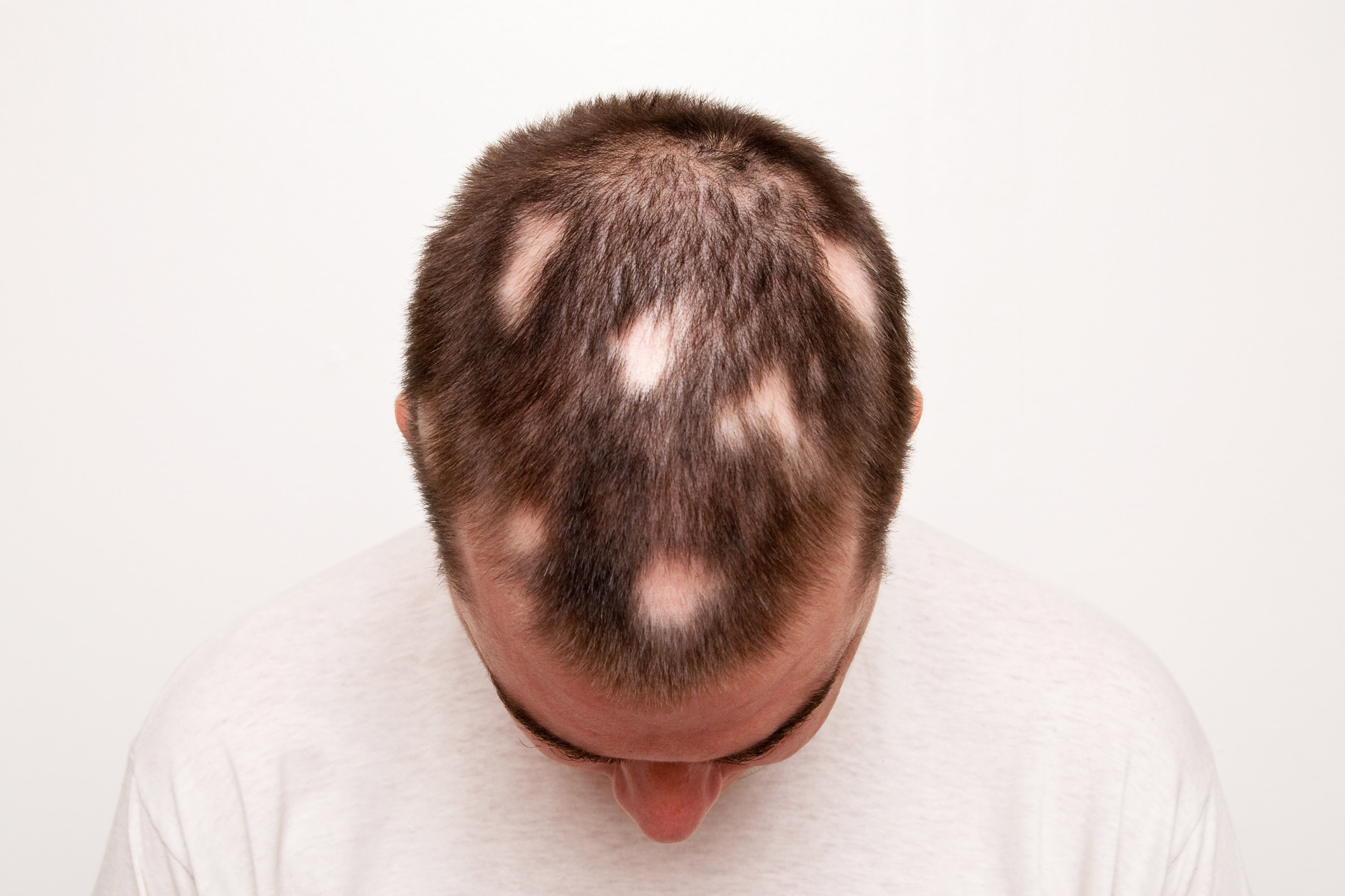 Alopecia Community and Discussion Center