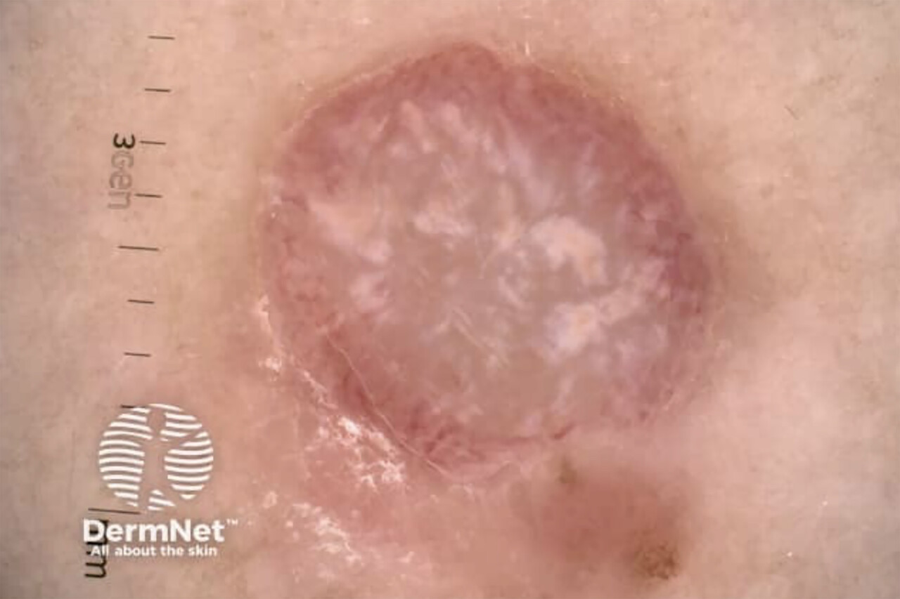 What Does a Cancerous Mole Look Like?