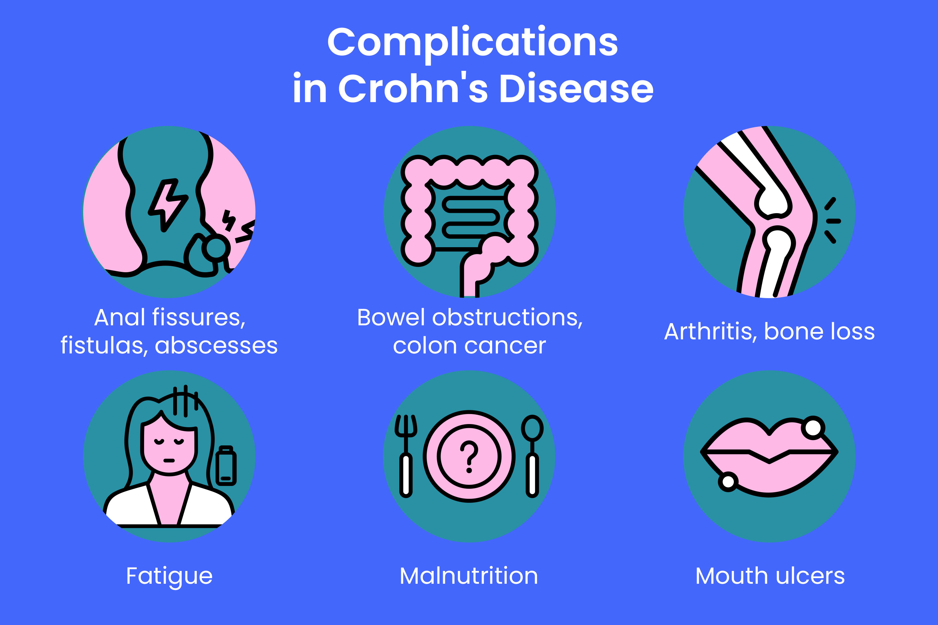 Crohn’s Disease Complications: Obstruction, Fistulas and More