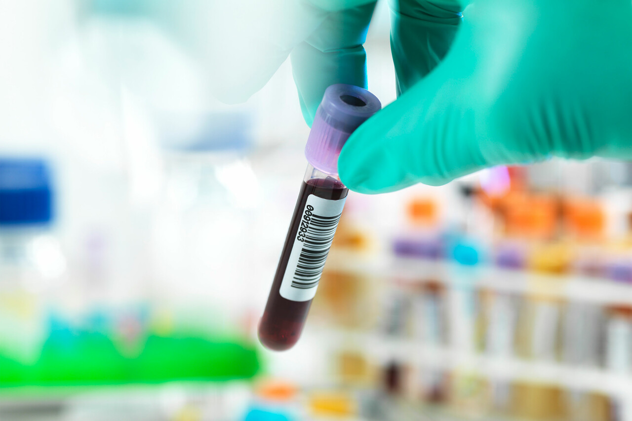 CCP Testing for Rheumatoid Arthritis