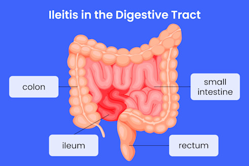 Crohn’s Ileitis: Symptoms, Treatment, and Management