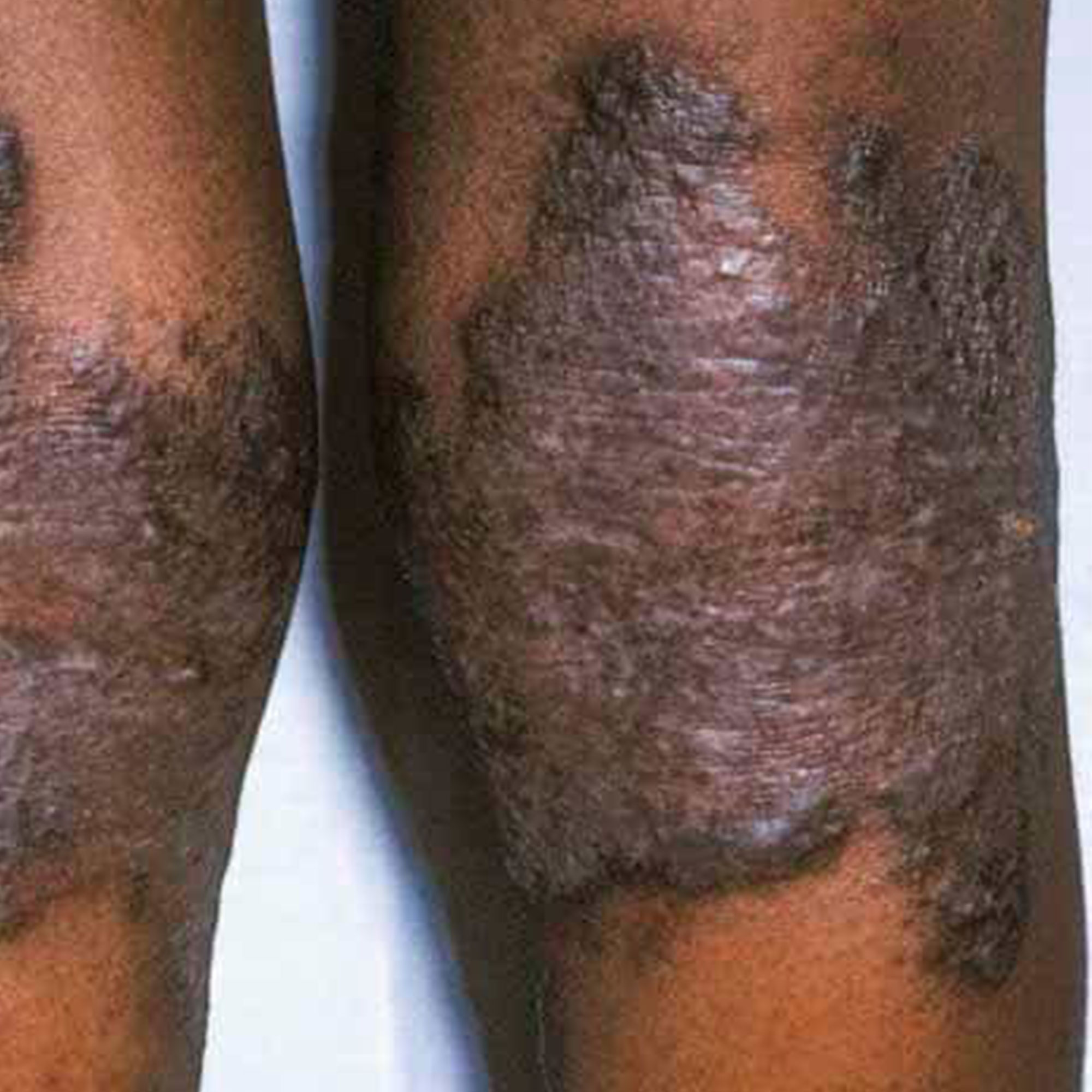 Our Visual Guide to Eczema on Skin of Color
