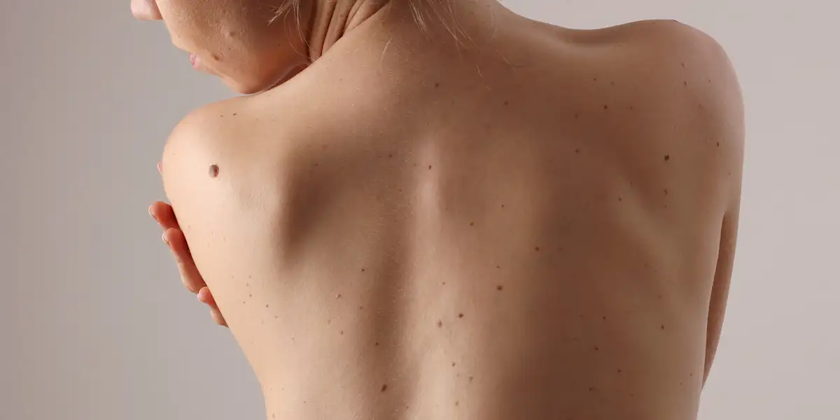 What Does a Cancerous Mole Look Like? What Does a Cancerous Mole Look Like?