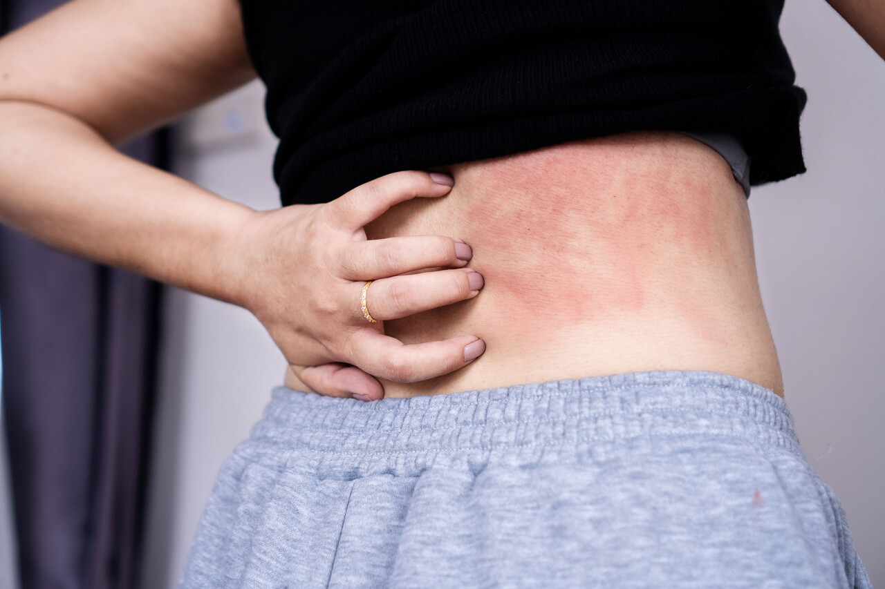 Why Chronic Hives Itch So Much—and How to Stop Scratching for Good