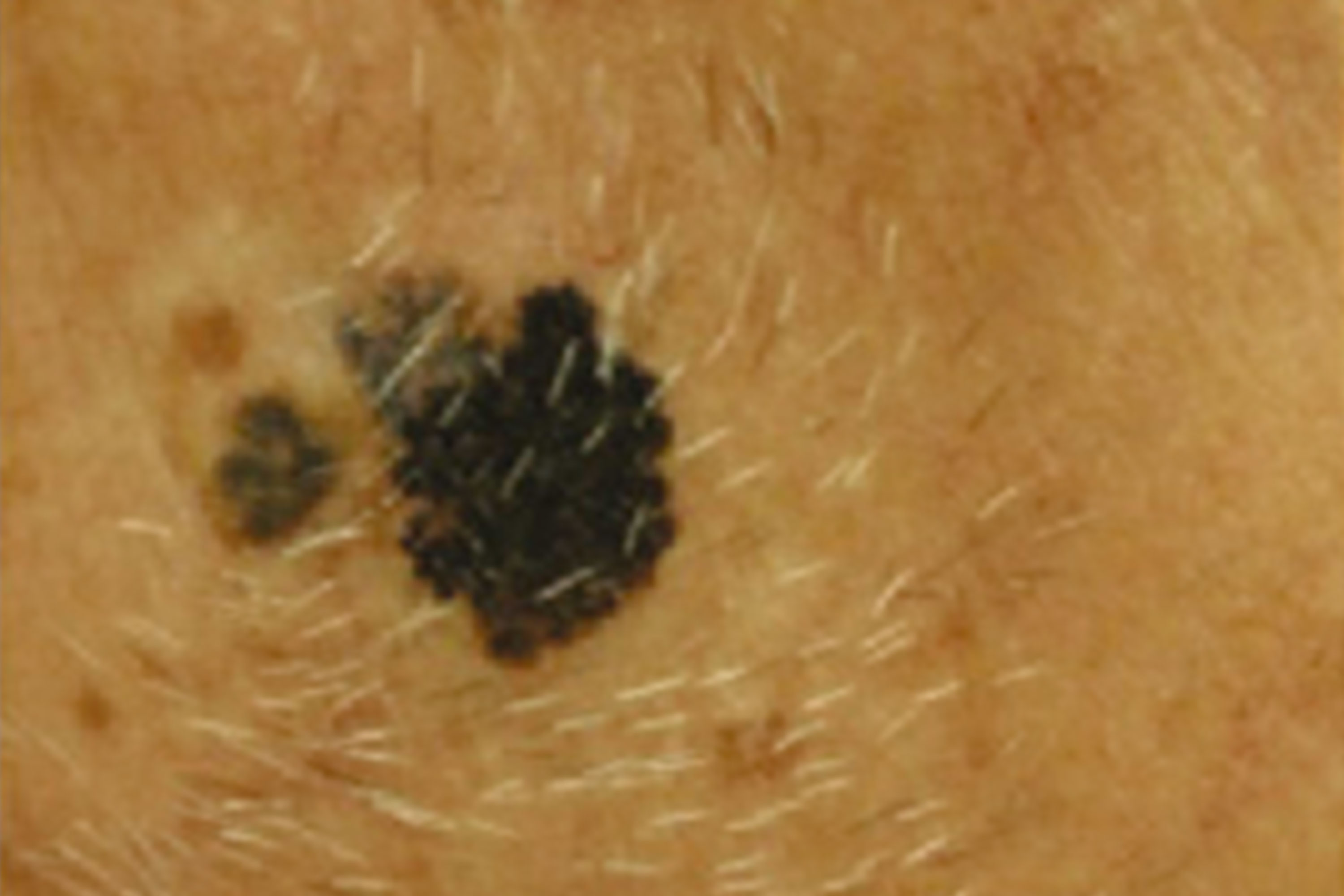 Melanoma on Dark or Black Skin: How to Identify It, Types and More