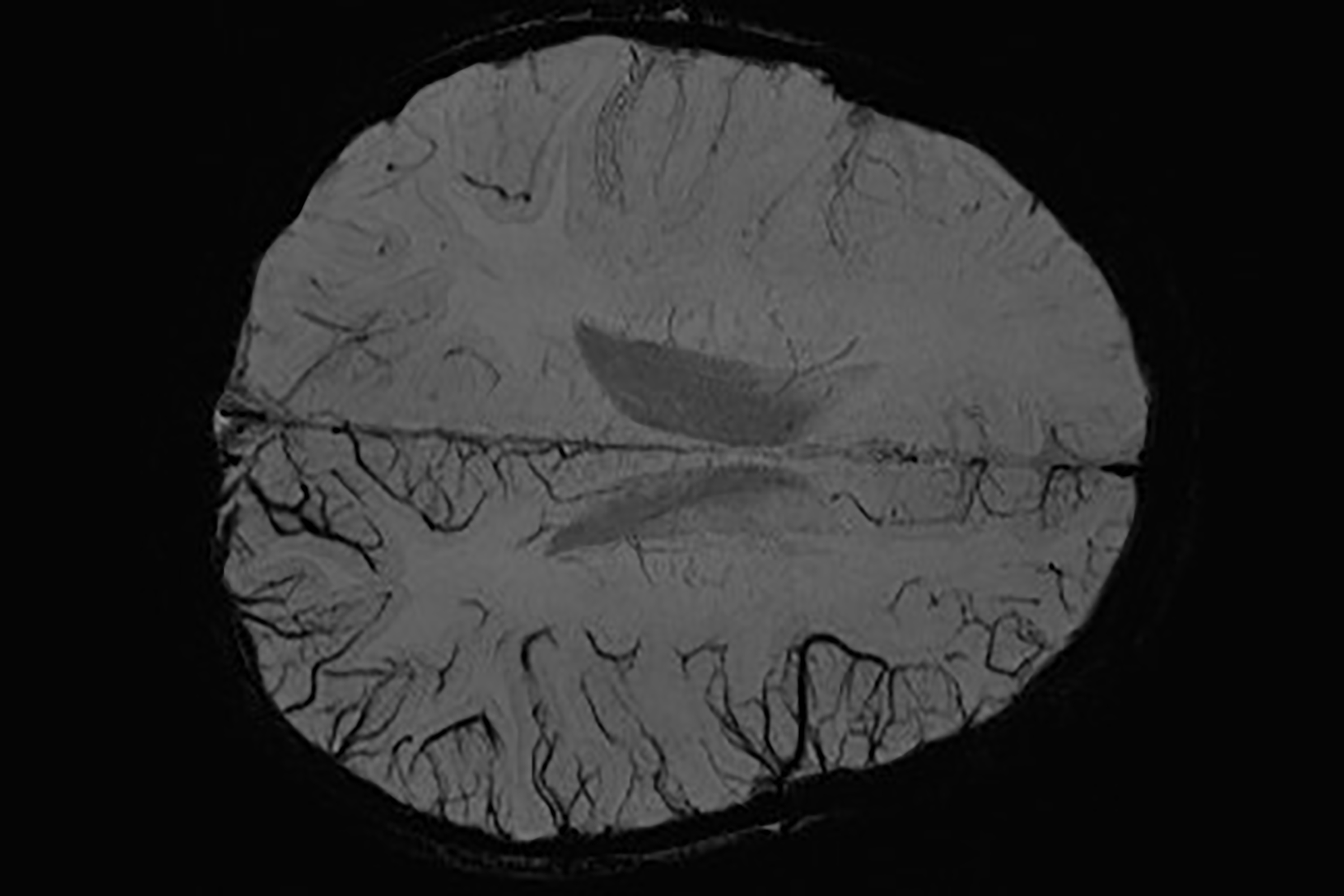 Hemiplegic Migraine: Causes, Symptoms & Treatment