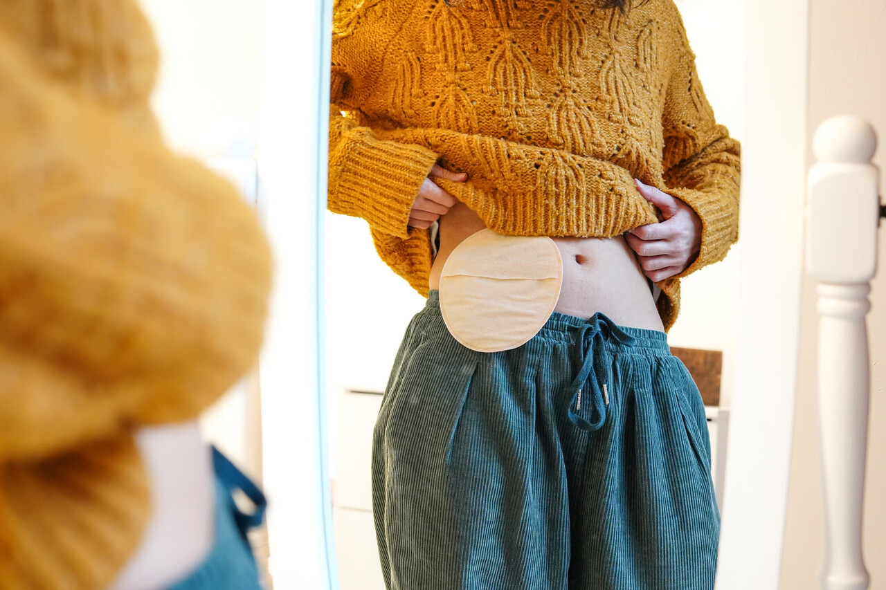 Diversion Colitis: Causes, Symptoms & Treatment