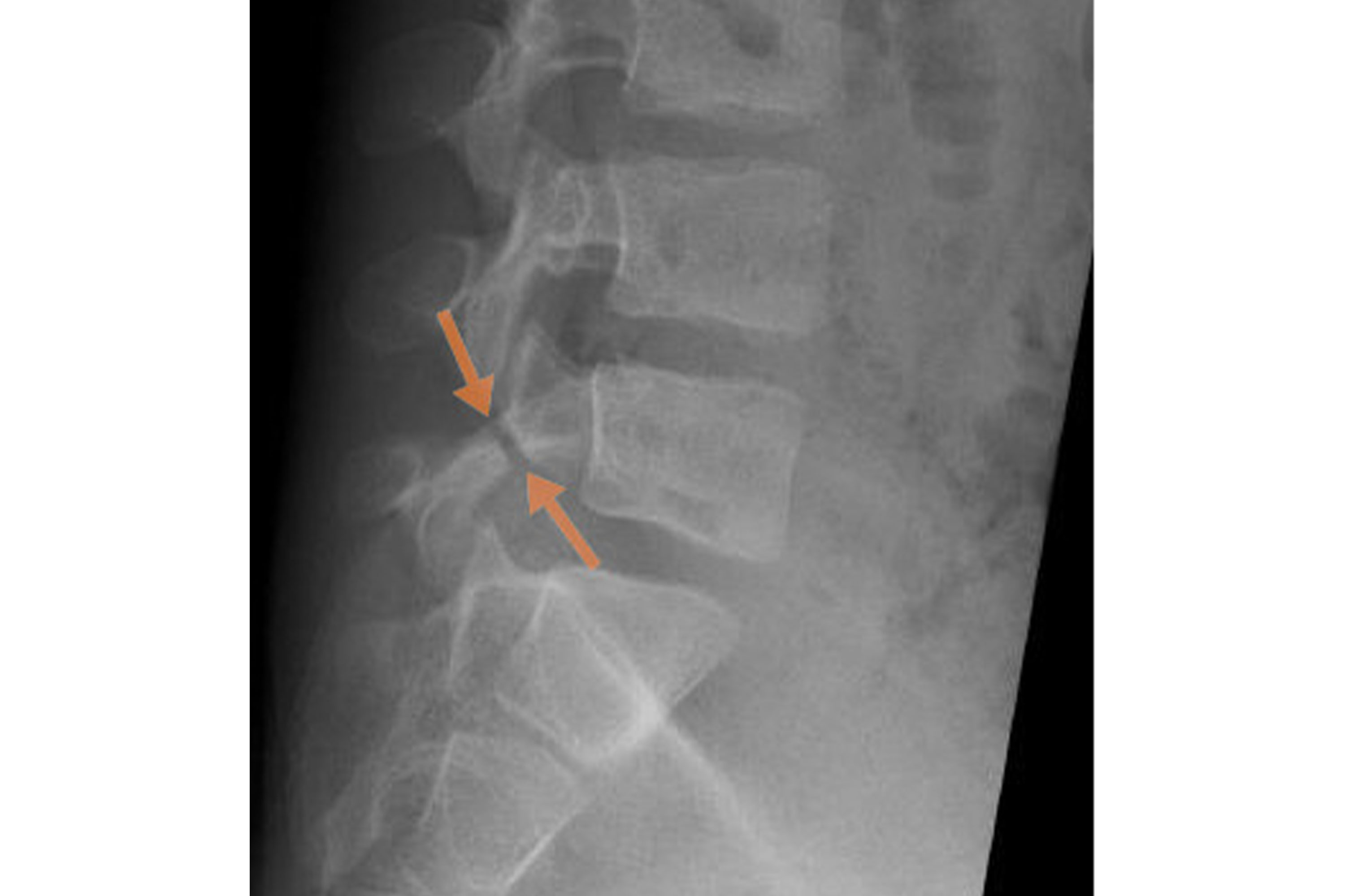 How to Prevent Pars Fractures