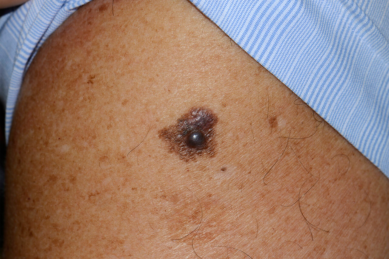 Melanoma Stage 4 Symptoms