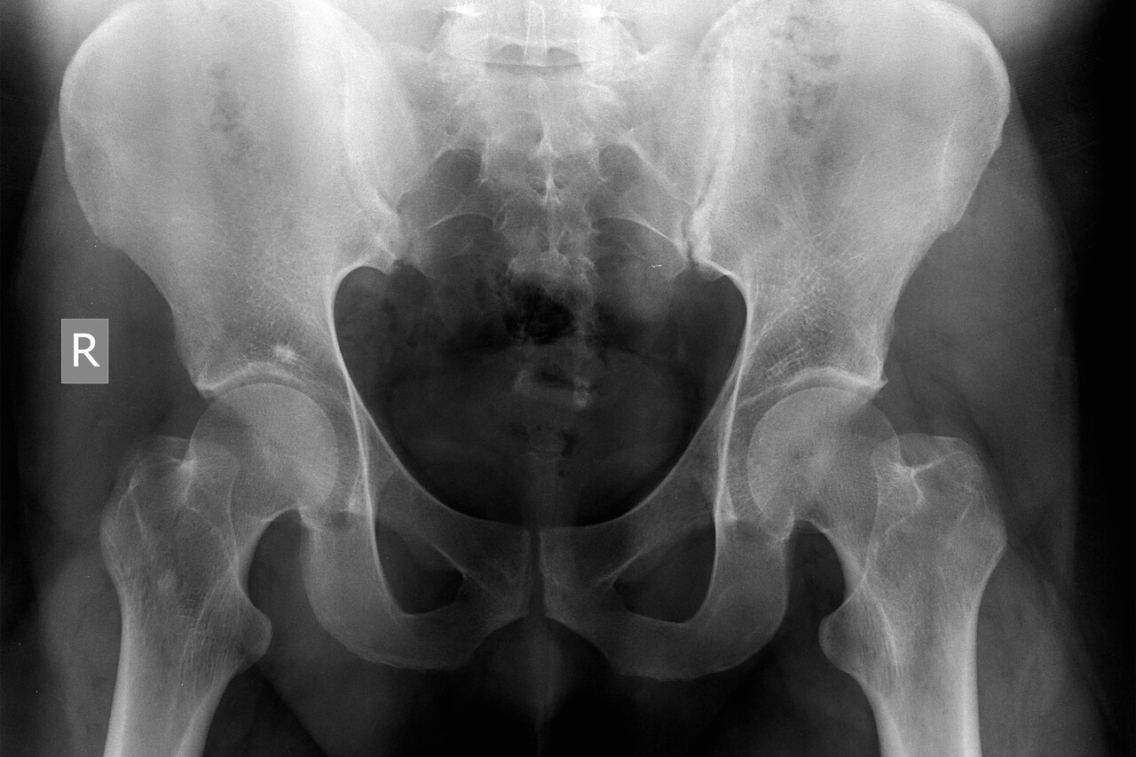 Psoriatic Arthritis Hip Pain: Causes and Relief Strategies