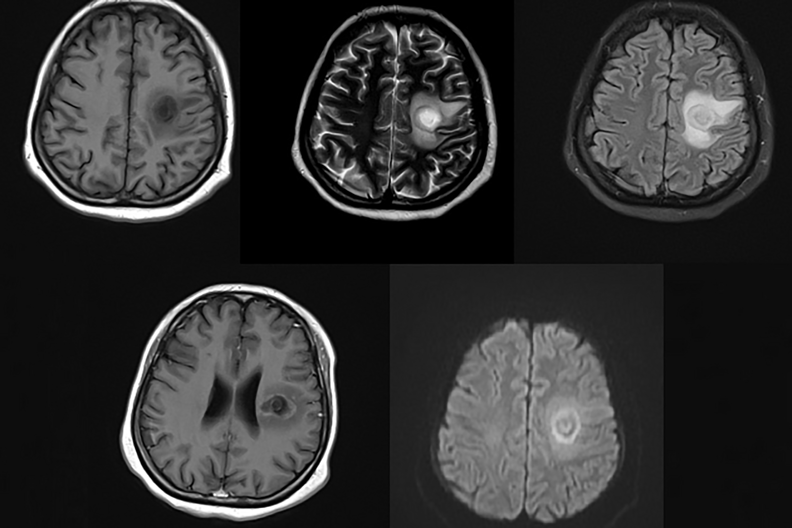 What is Baló Concentric Sclerosis (BCS)?