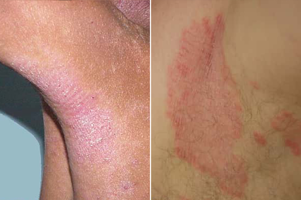 Pictures of Eczema and Psoriasis: On Face, Hands and More