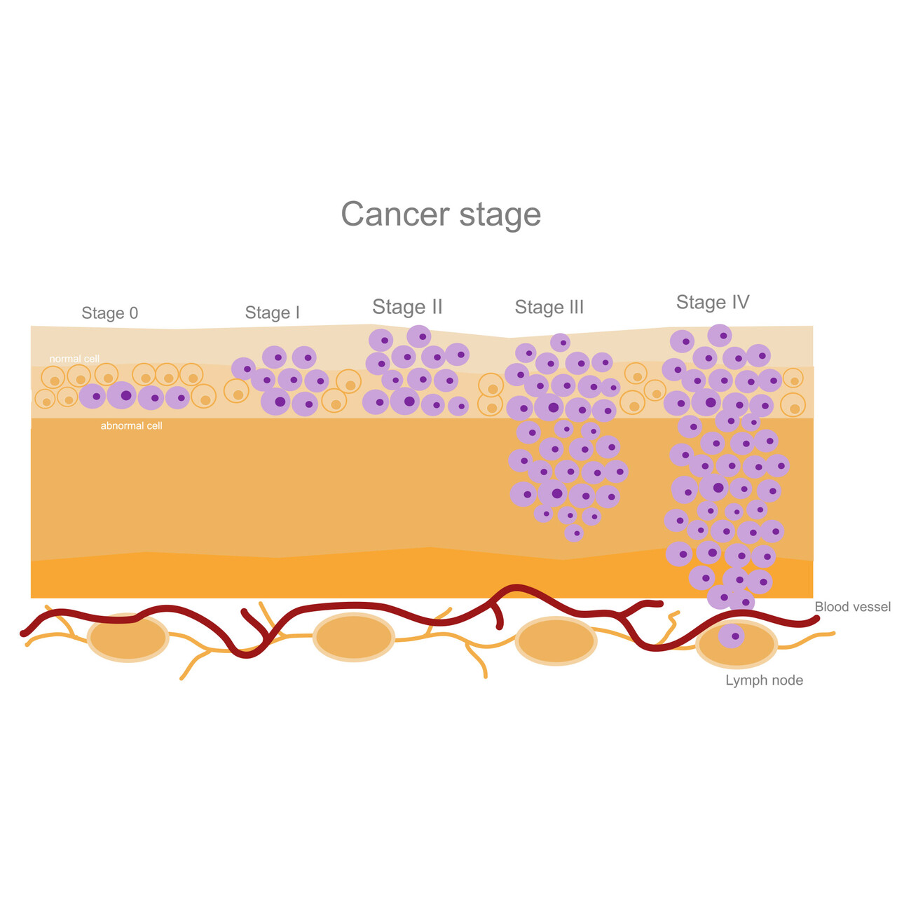 Why Staging Matters With RRMM