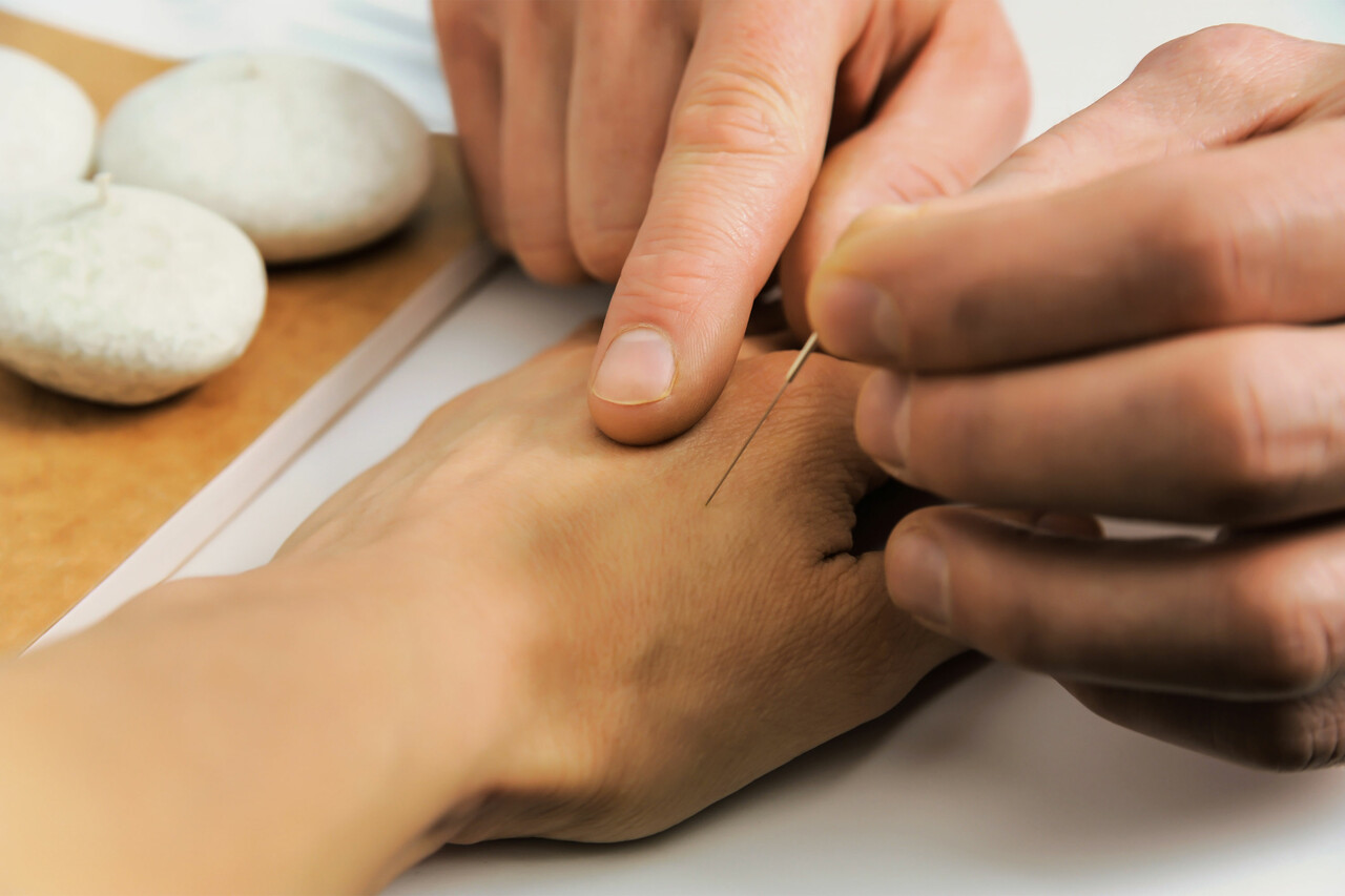Should You Consider Acupuncture for Eczema?