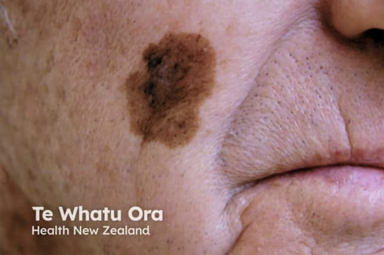 What Does a Cancerous Mole Look Like?