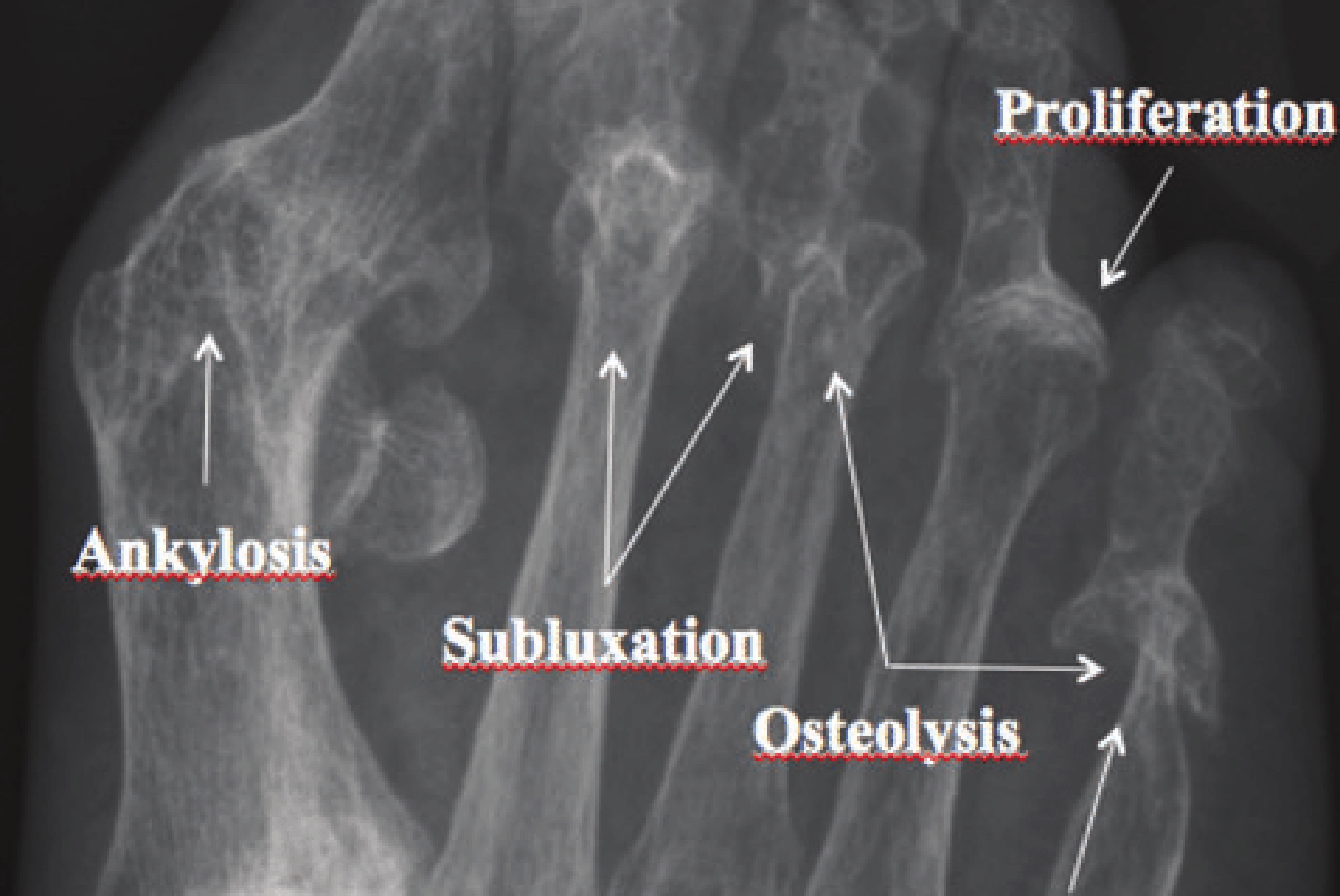 Psoriatic Arthritis Mutilans: Pictures, Symptoms, and More