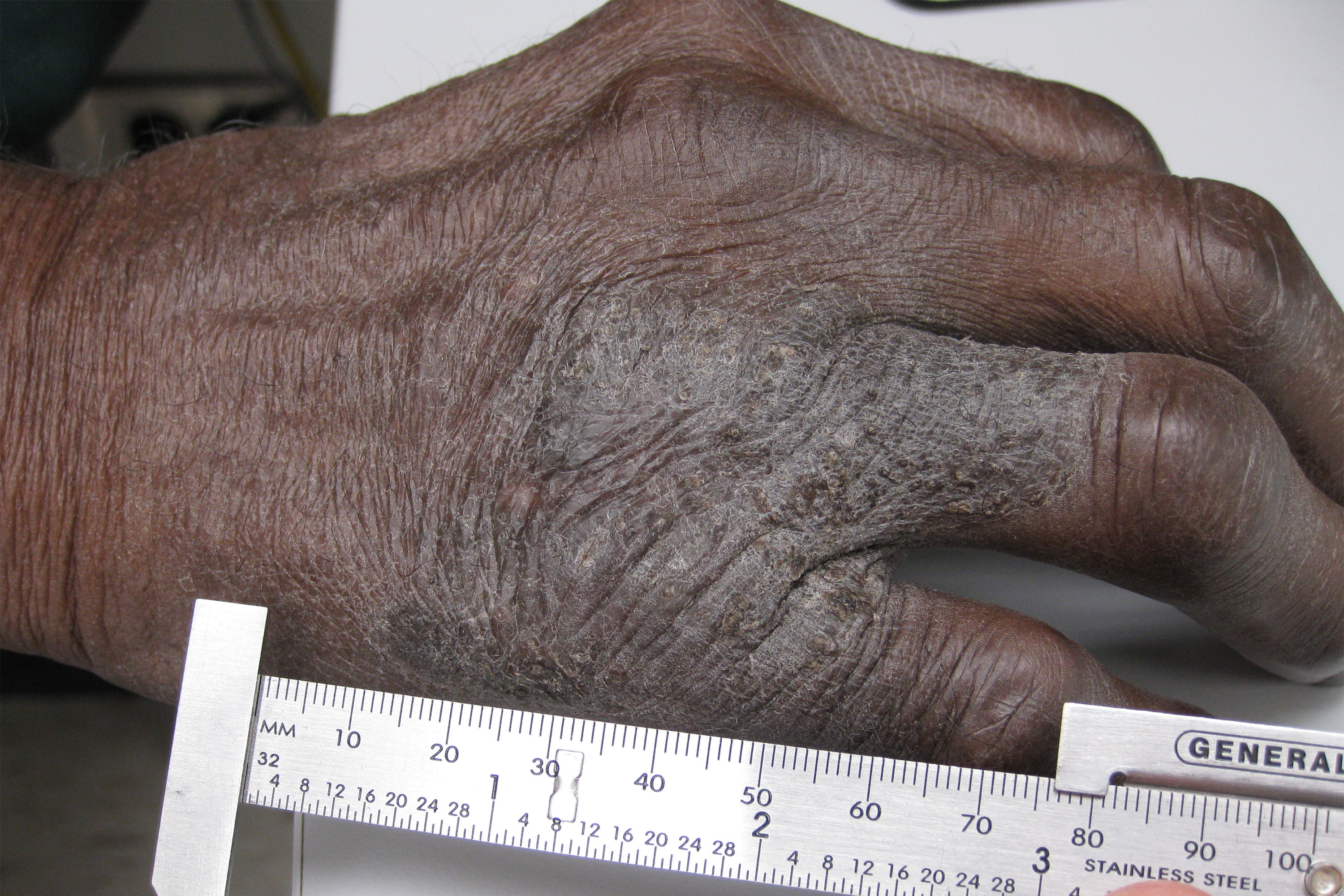 Eczema Types: Dyshidrotic, Seborrheic, Nummular and More