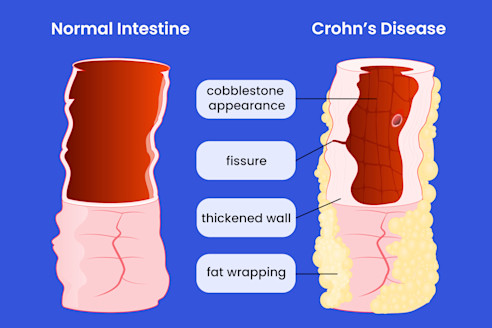 What to Know About Creeping Fat in Crohn’s Disease